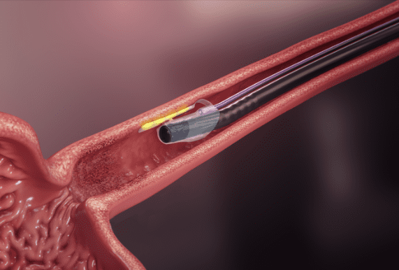 MiVu Mucosal Integrity Testing System - Diversatek
